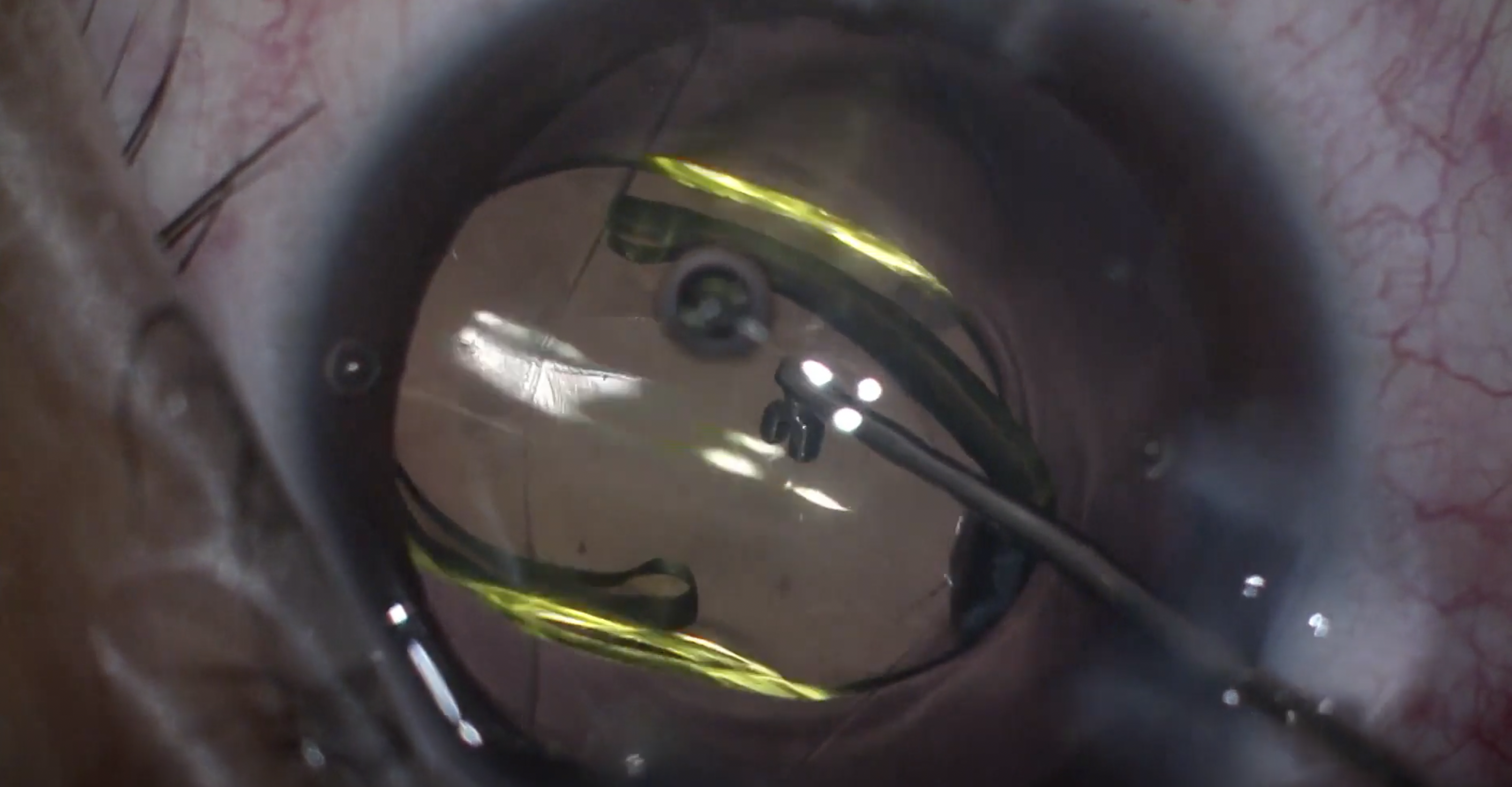 Intumescent Cataract